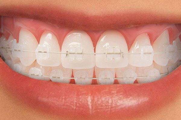 Orthodontics - types of braces, invisible orthodontics, and more