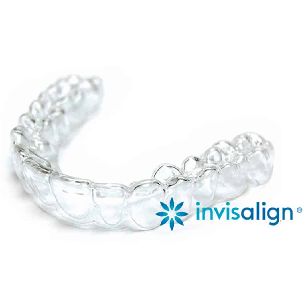 🦷 Invisalign Lite: Clear Aligners for Mild to Moderate Alignment
