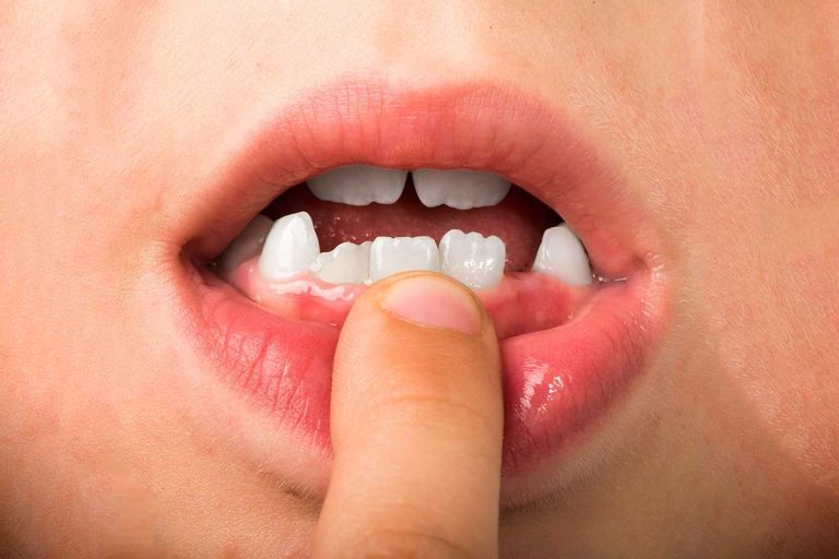 Tooth agenesis - Causes, types, consequences and solutions