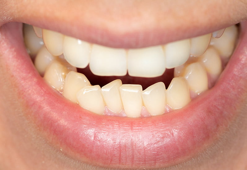Teeth Crowding: Causes, Treatment, and Prevention Guide